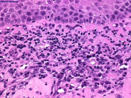 Balanite | MedicinaLive